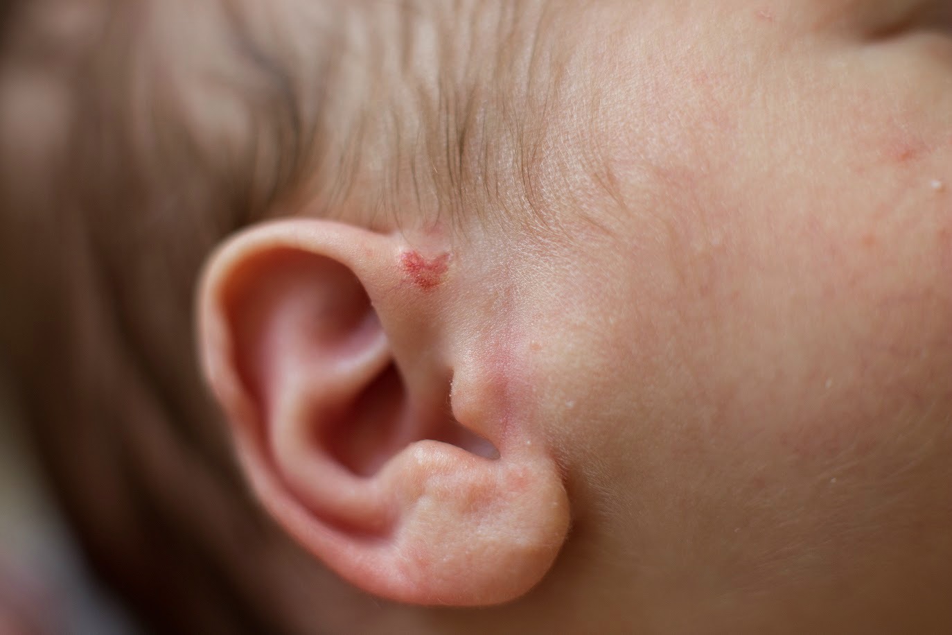 Lawson Was Born With A SHOCKING Birthmark - Budget Savvy Diva