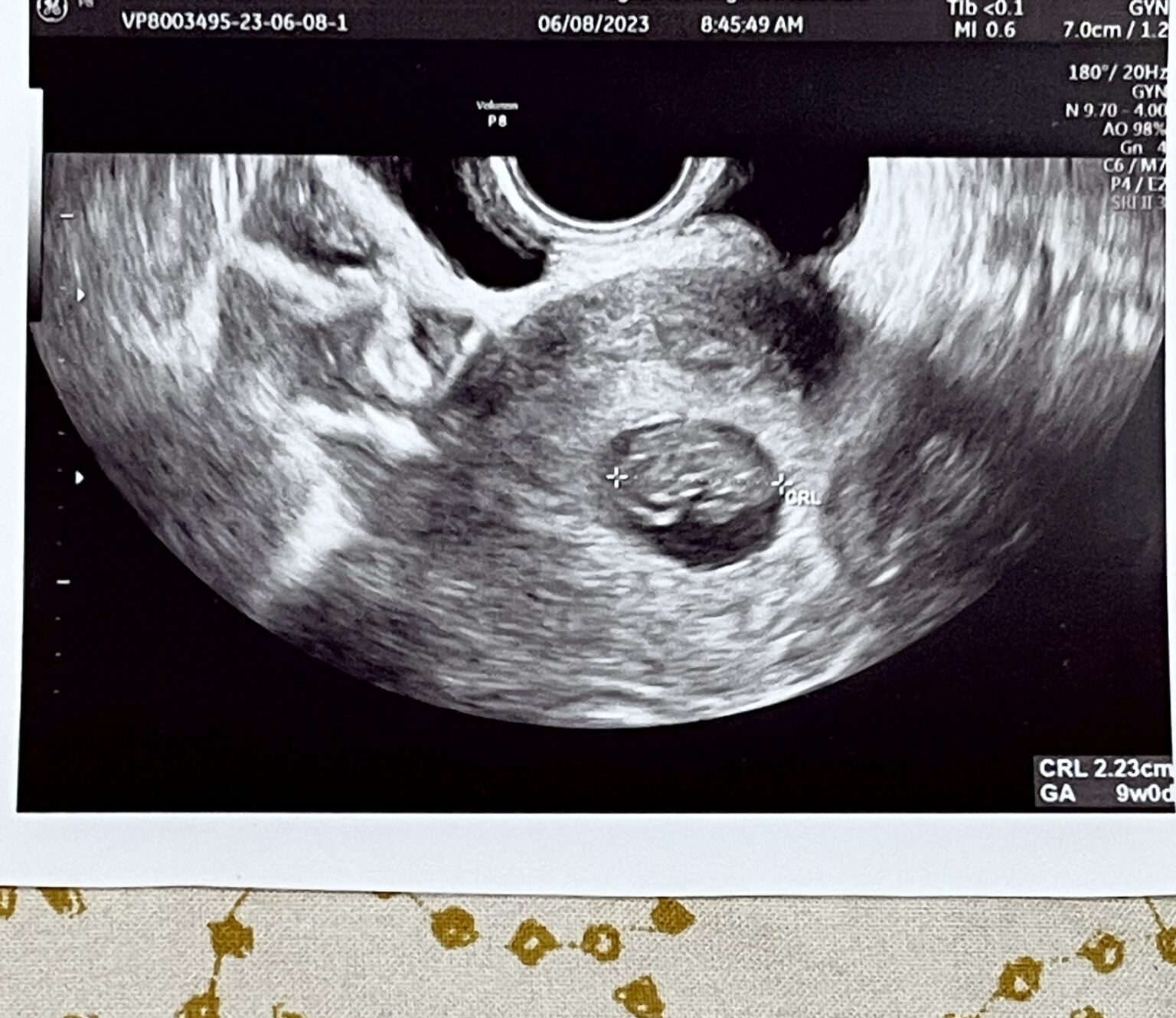 Facing a Small Gestational Sac: What You Need to Know - Budget Savvy Diva